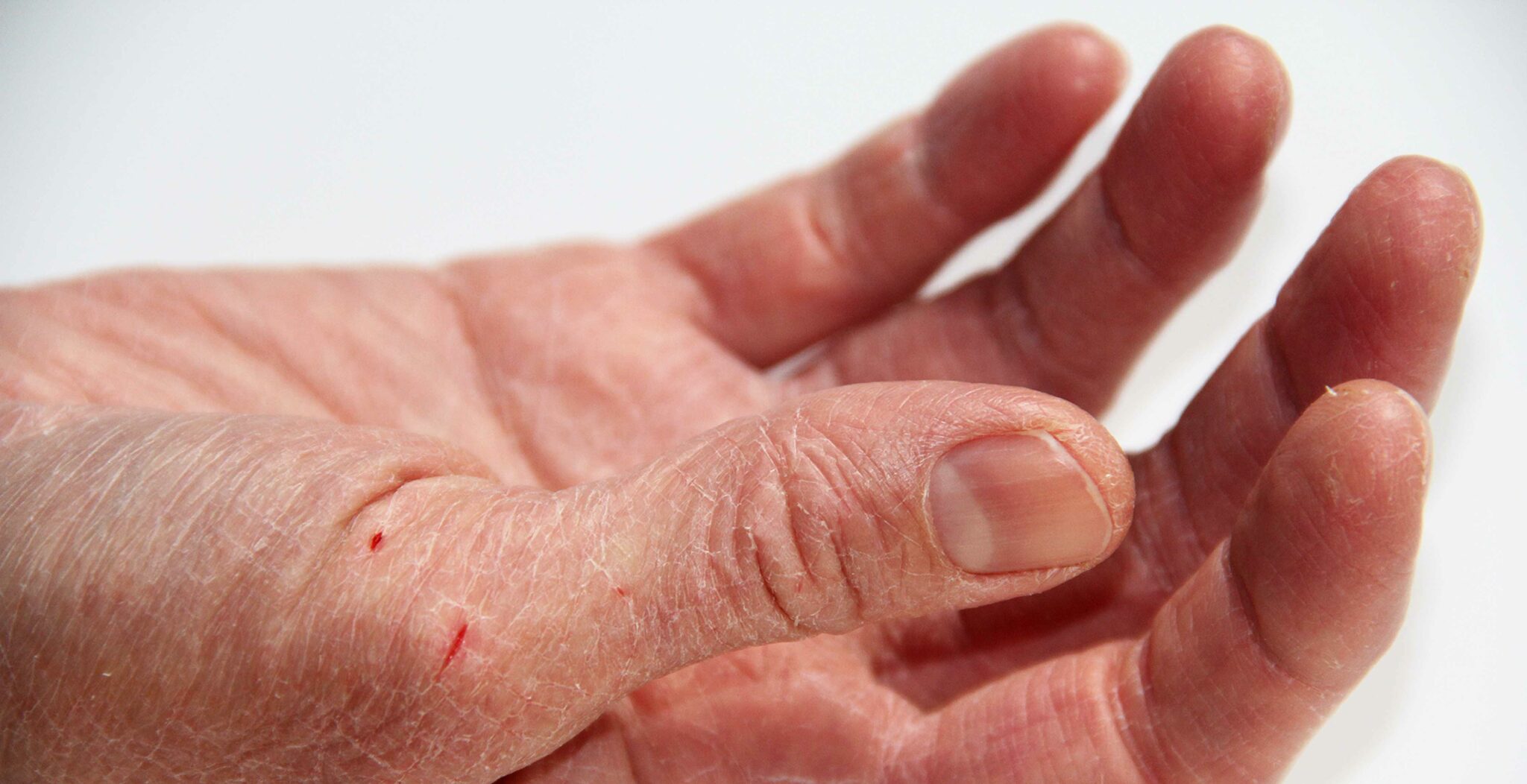 Mains sèches et gercées : causes et remèdes | Dr Cormary | Lyon