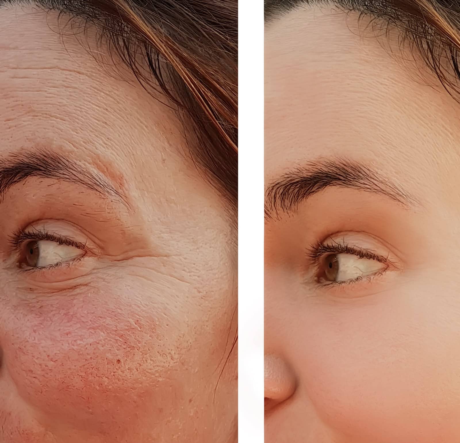 Qu’est-ce que le mesobotox | Dr Cormary | Lyon