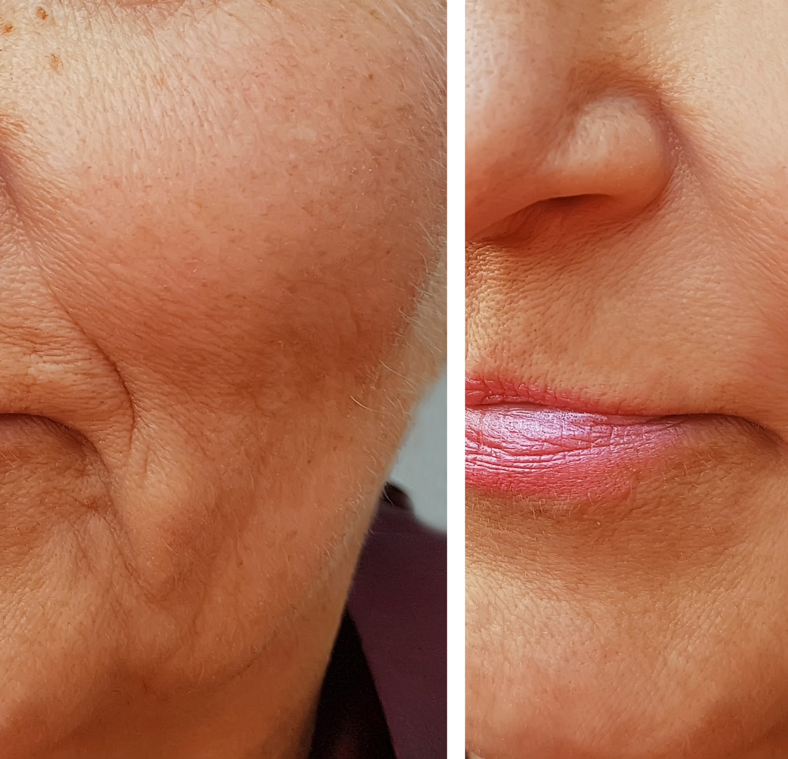 Acide hyaluronique : l'ingrédient secret pour une peau jeune et ...